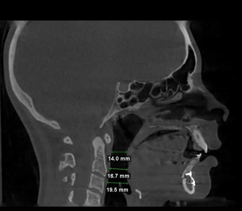 Jaw Surgery Before & After | Oral Surgeon Scottsdale AZ