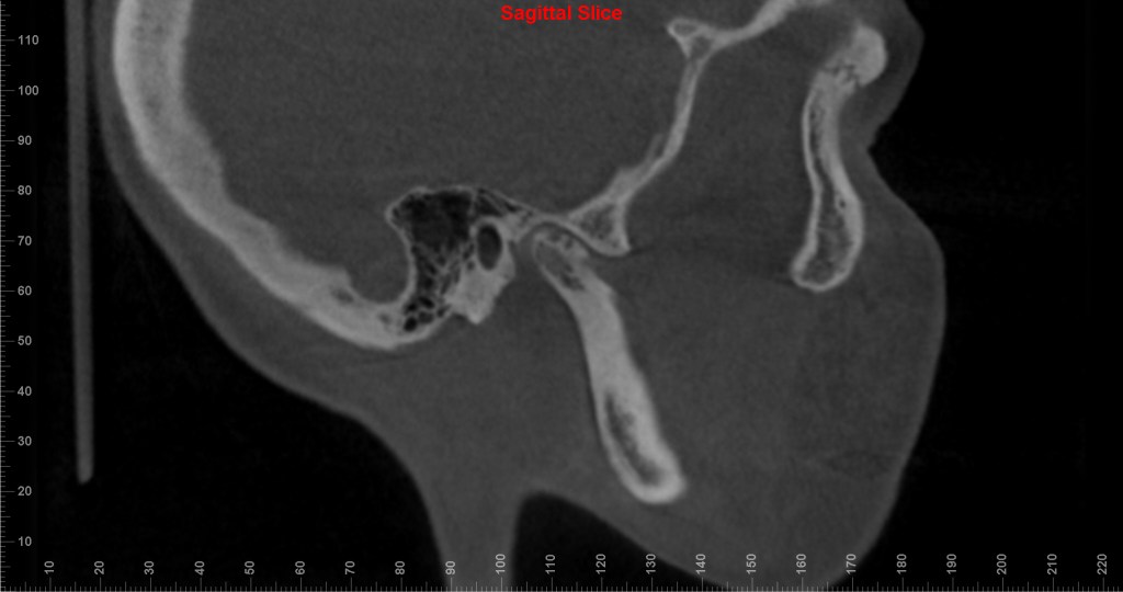 TMJ Surgery Gallery Scottsdale AZ, Arizona Jaw Surgery