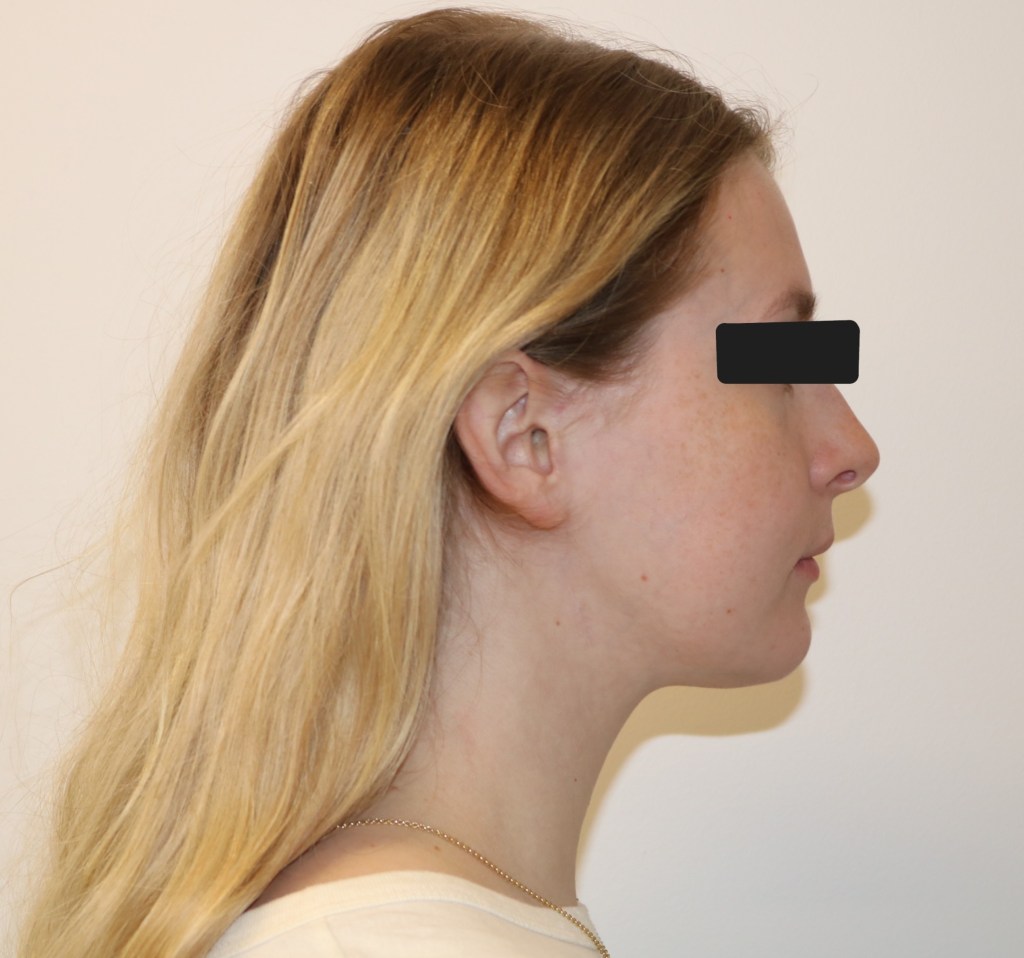 TMJ Surgery Gallery Scottsdale AZ, Arizona Jaw Surgery