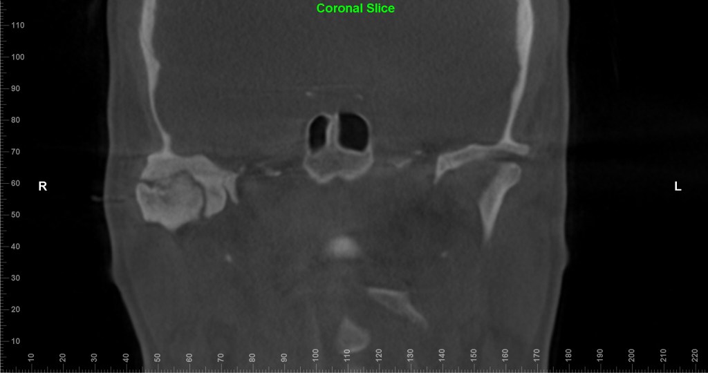 TMJ Surgery Gallery Scottsdale AZ, Arizona Jaw Surgery