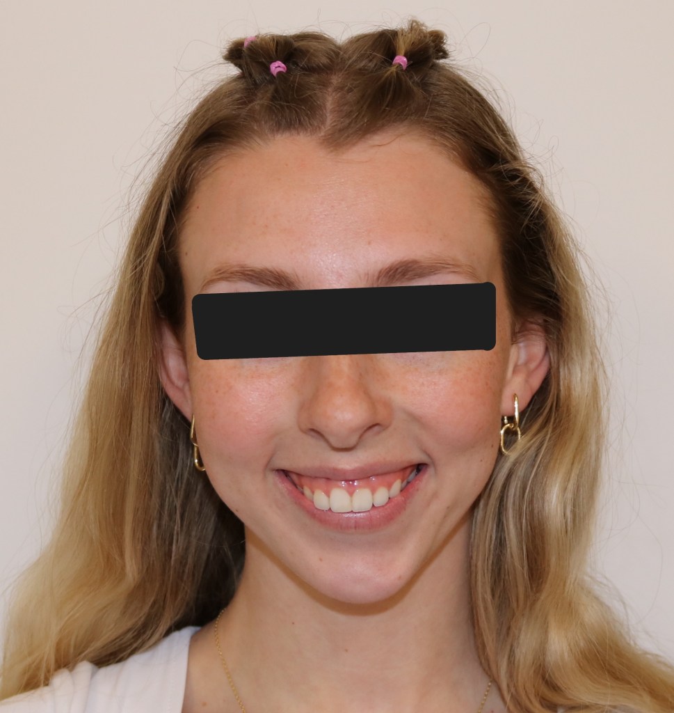 TMJ Surgery Gallery Scottsdale AZ, Arizona Jaw Surgery