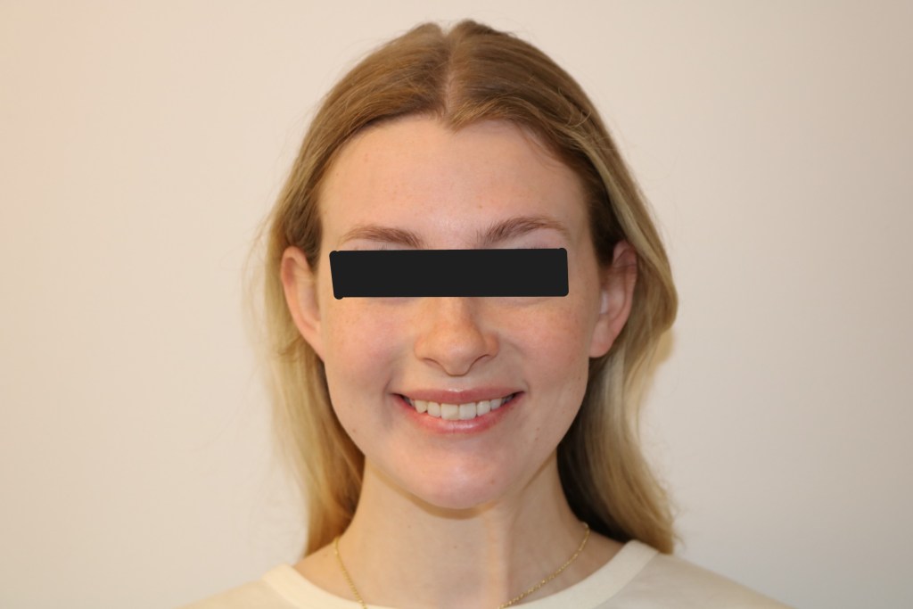 TMJ Surgery Gallery Scottsdale AZ, Arizona Jaw Surgery