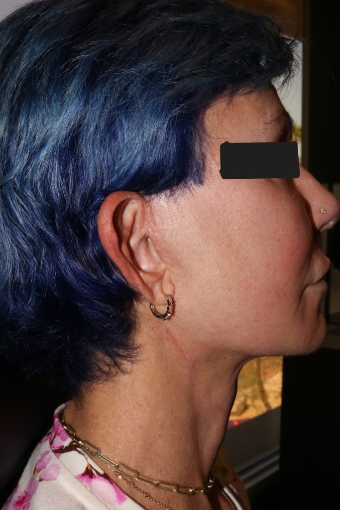 TMJ Surgery Gallery Scottsdale AZ, Arizona Jaw Surgery
